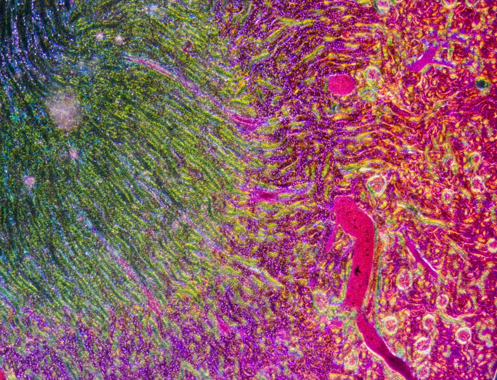 Fda Approves Osimertinib With Platinum Based Chemotherapy In Egfr Mutated Nsclc Vjoncology